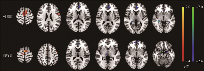 基于静息态功能核磁共振观察天王补心丹加减方对功能性便秘伴情绪障碍的影响